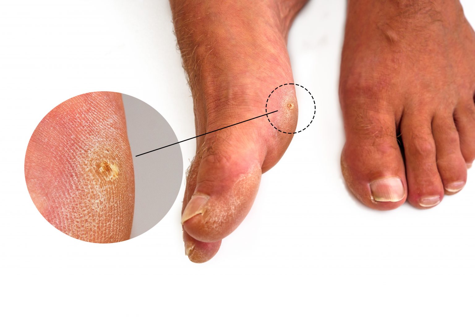 Corn vs. Callus vs. Wart - Darwin Podiatry
